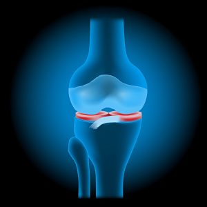 Meniscus Repair vs. Meniscectomy - kerlan jobe