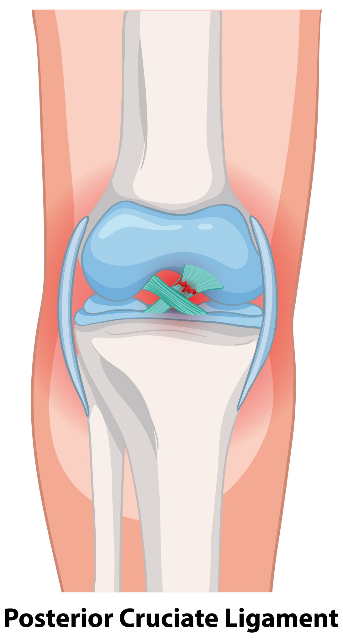 PCL Injuries - kerlan jobe